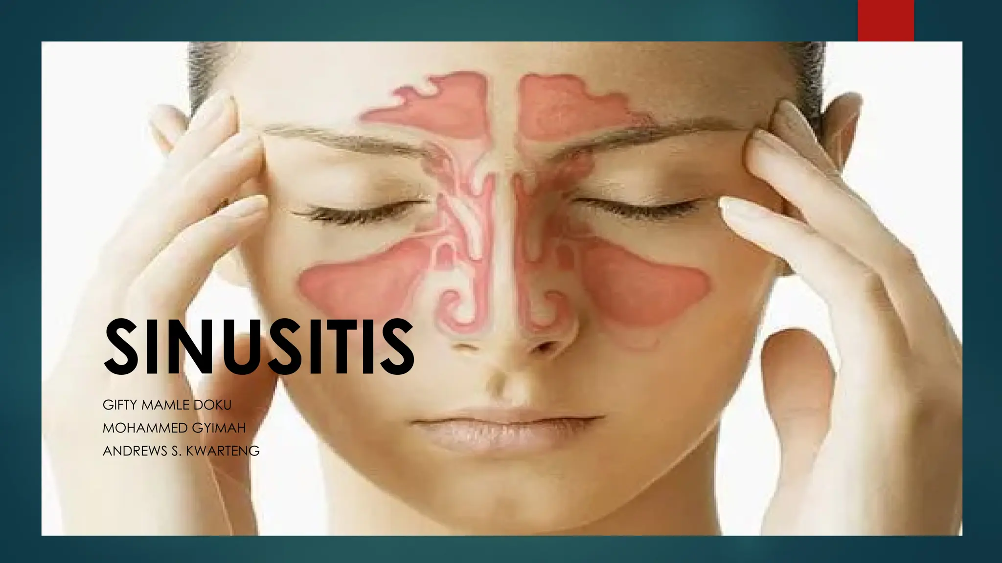 SINUSITIS-2NEW-1.pptx. Management of sinusitis | PPTX