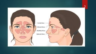 SINUSITIS-2NEW-1.pptx. Management of sinusitis | PPTX