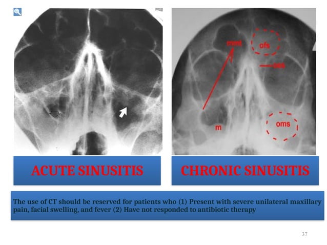 sinusitis advanced.powerpoint presentations | PPTX