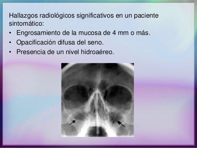 Sinusitis aguda