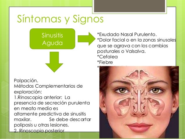 Sinusitis aguda