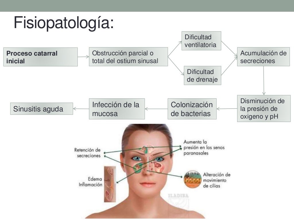 Sinusitis aguda Alumno: Fernández Gutiérrez Willignton Dr.: Guillermo…