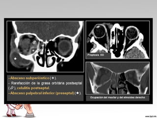 barco Difuminar Drama sinusitis aguda tac Algún día contraste Heredero