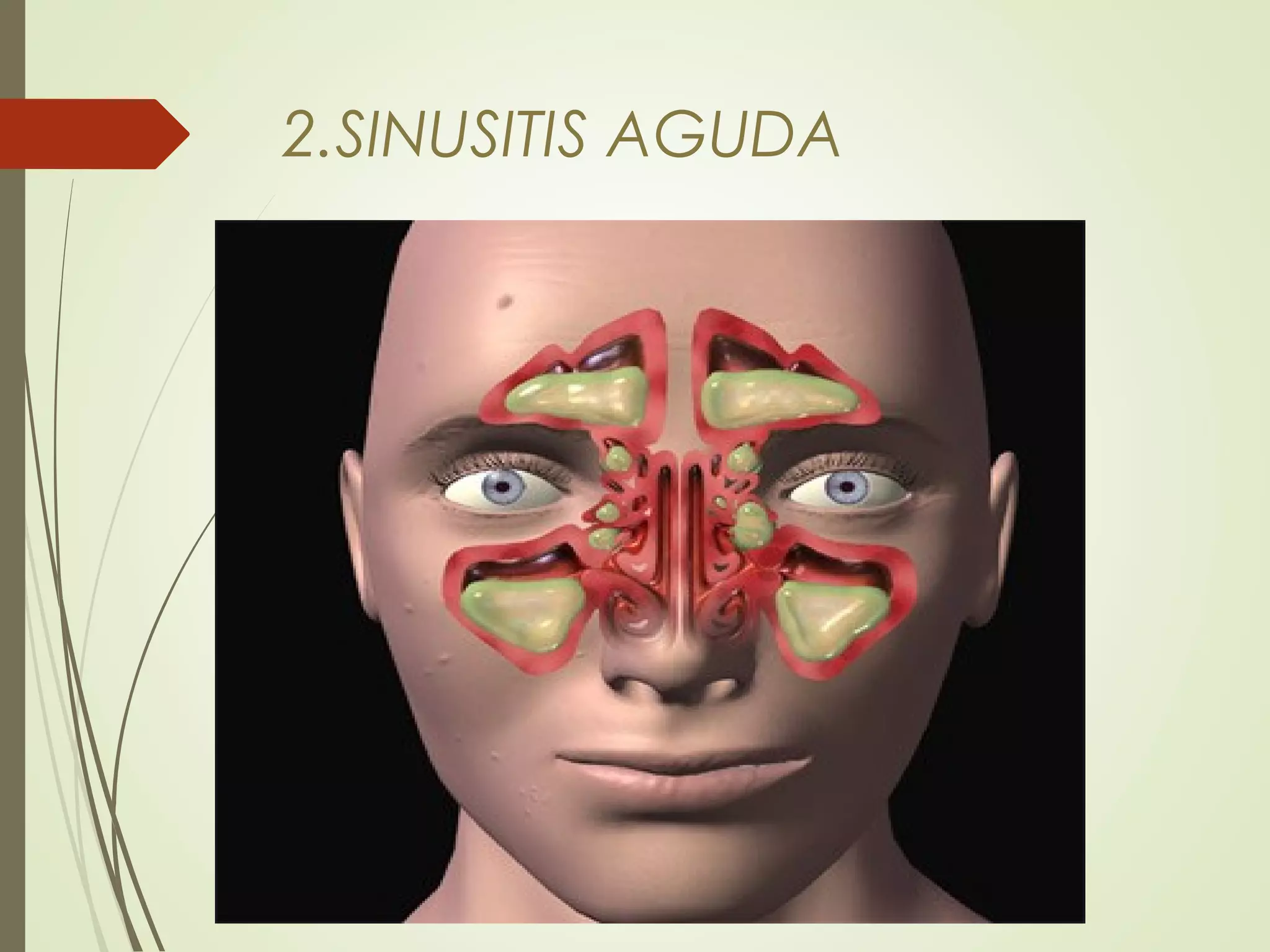 Sinusitis aguda cristian Sanchez Dr..Guillermo Fonseca | PPT