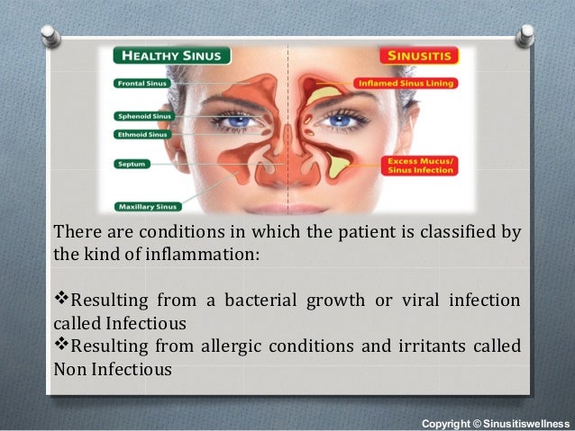 Sinusitis Disease: Symptoms & Precautions
