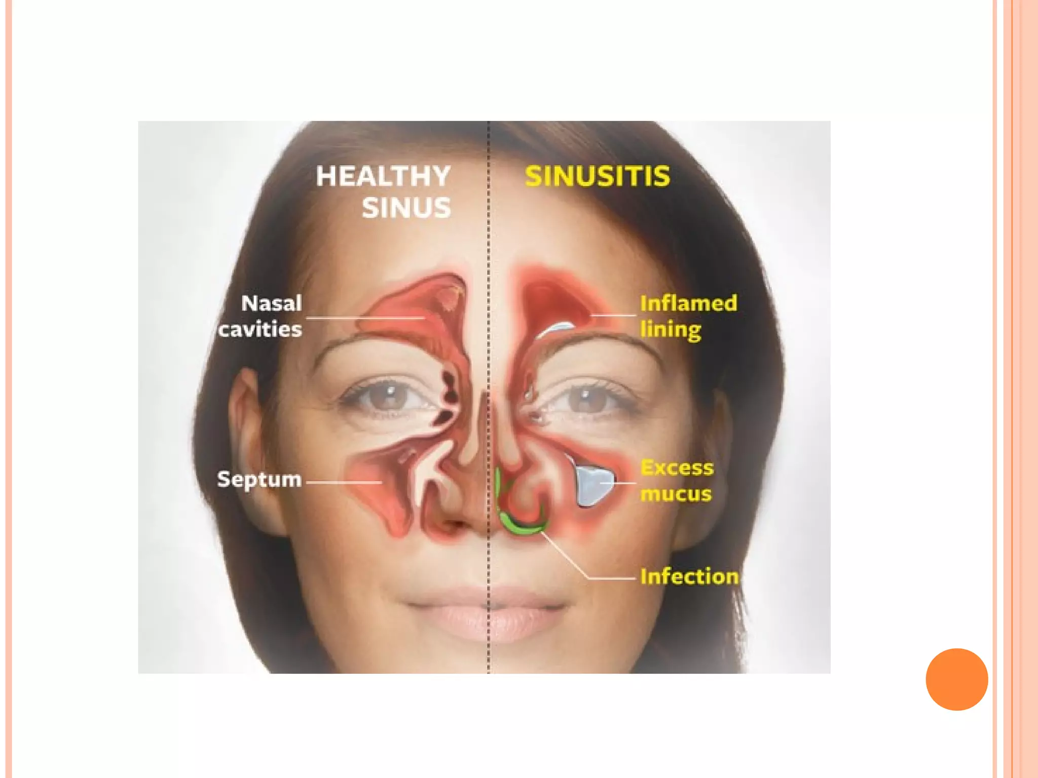 Sinusitis in children | PPT