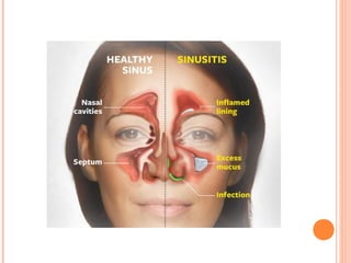 Sinusitis in children | PPT