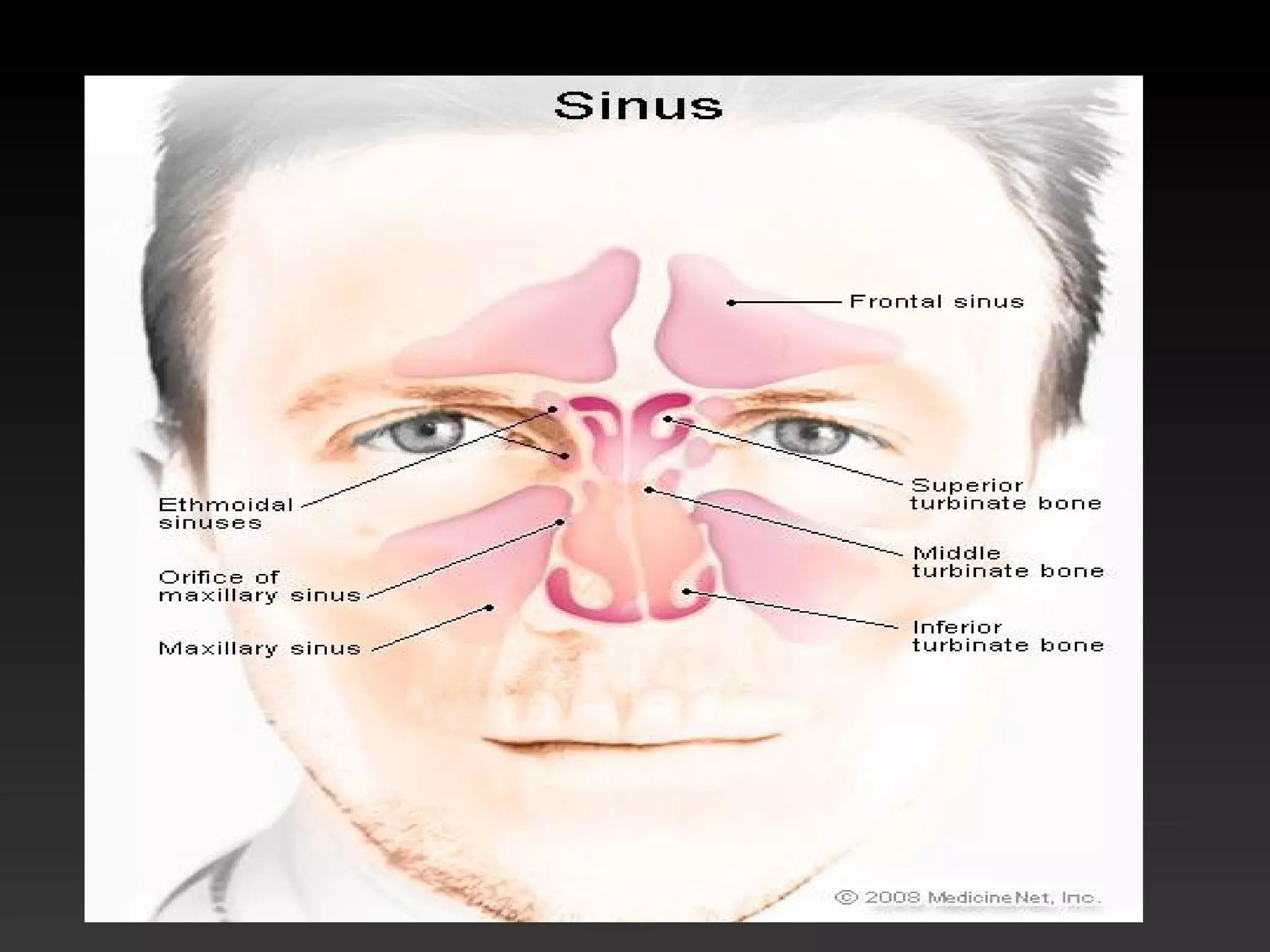 Sinusitis jamur fix | PPT