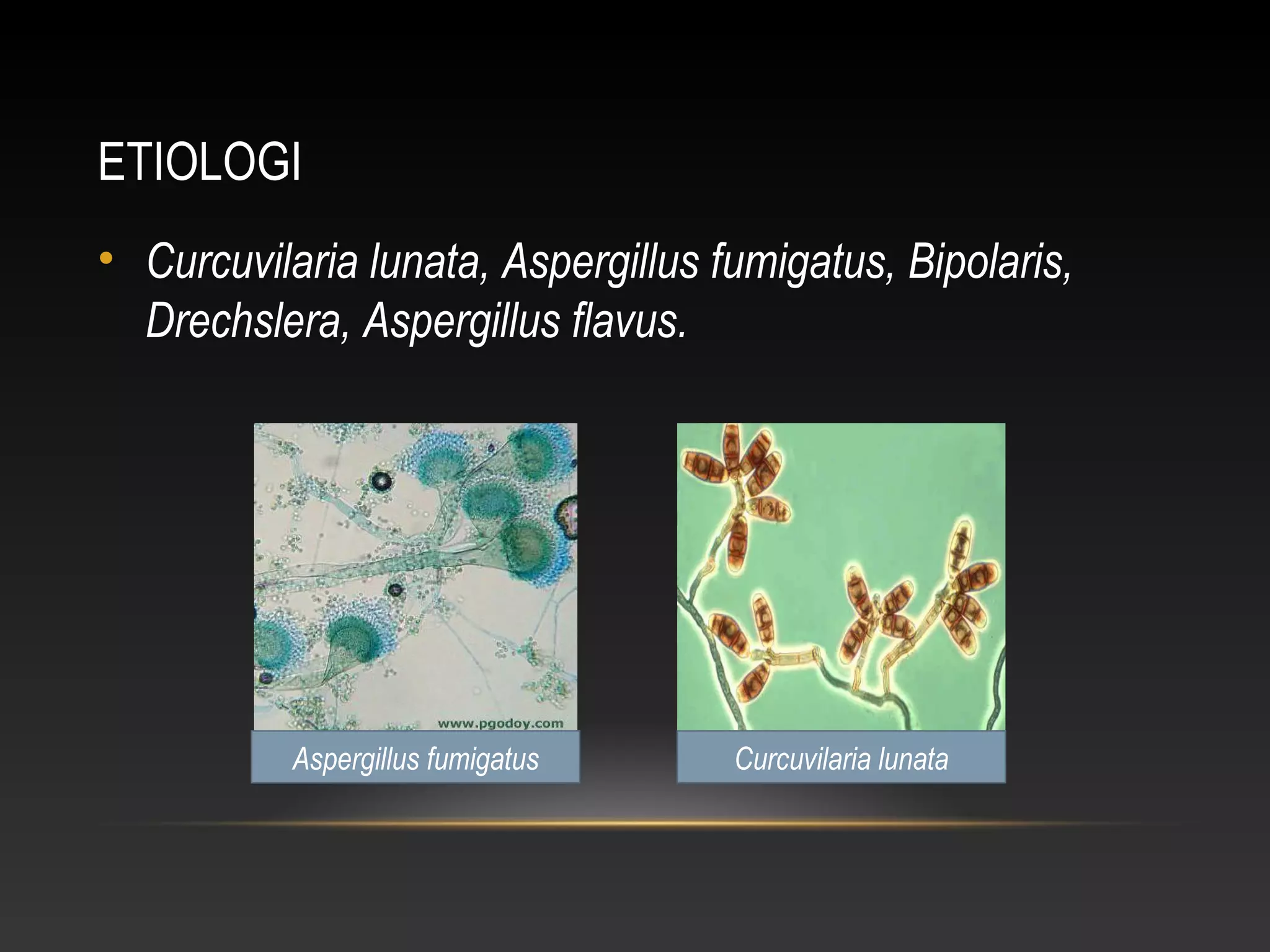 Sinusitis jamur fix | PPT