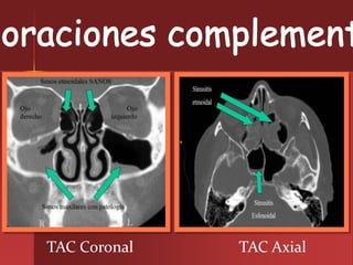 Sinusitis pediatria | PPTX