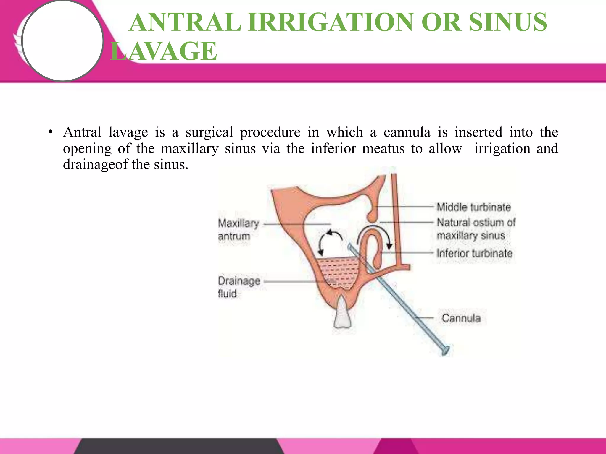 SINUSITIS PPT.pptx