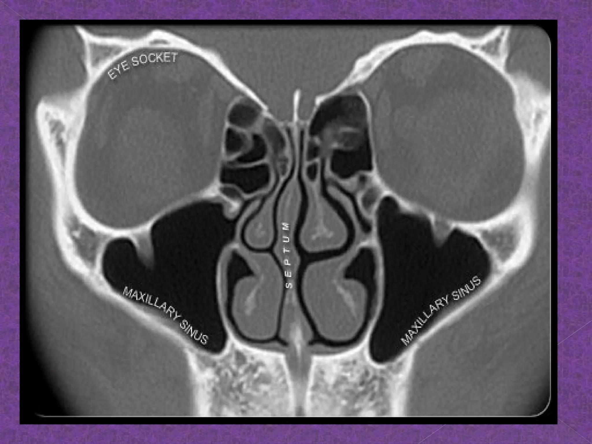 sinusitis presentation.pptxBBBBBBBBBBBBBB | PPT | Free Download