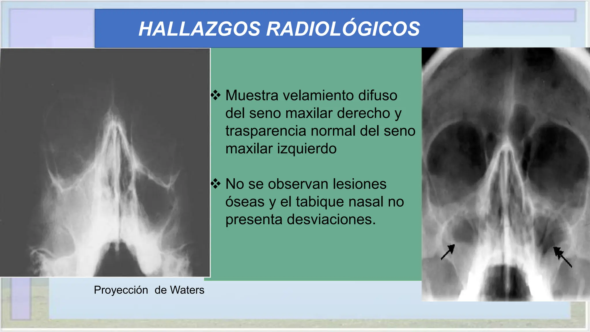 sinusitis cuadro clinico fisiologia, diagnostico y su tratamiento ...