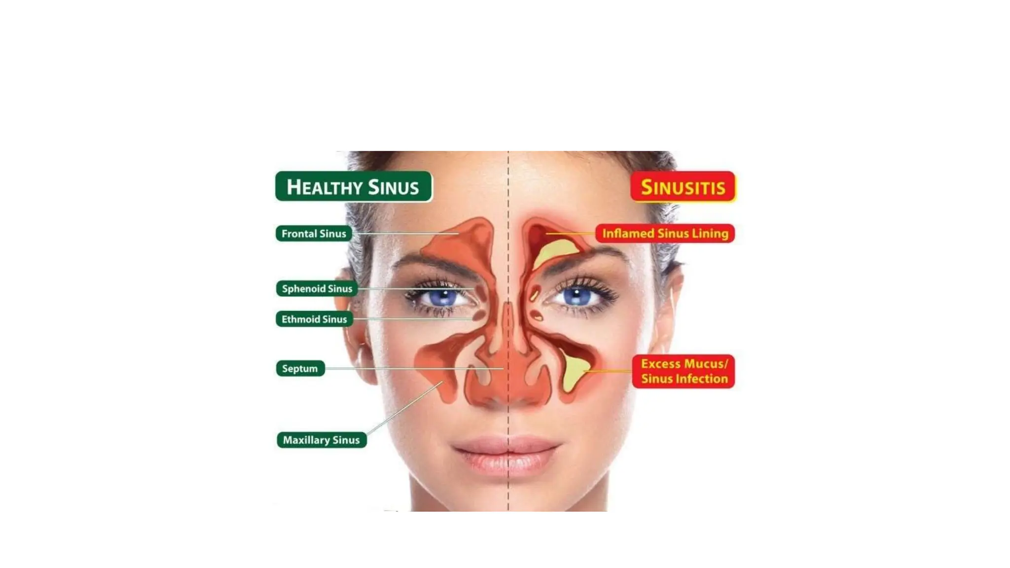 Sinusitis diagnosis and possible treatment.pptx