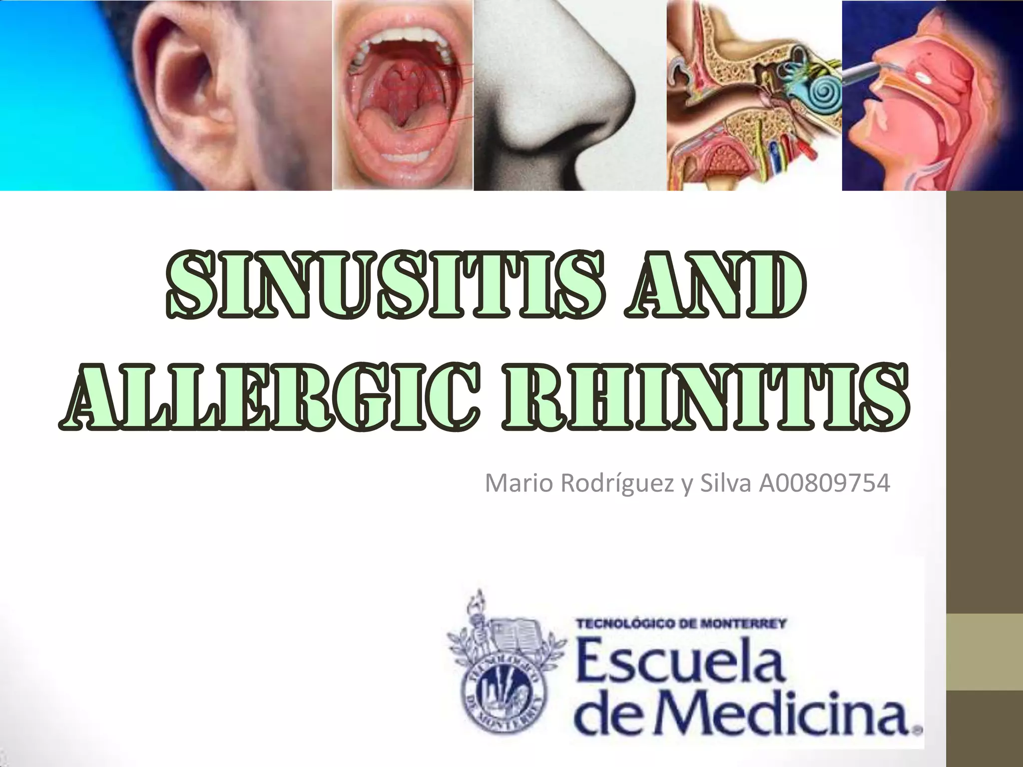 Sinusitis aguda y crónica- rinitis alérgica | PPTX