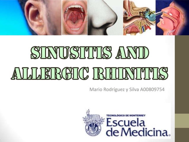 Sinusitis aguda y crónica- rinitis alérgica | PPTX