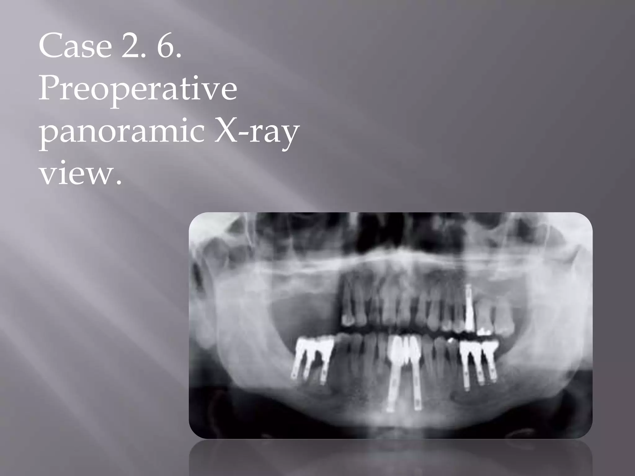 transcrestal sinus lift with implant placement-balloon technique | PPTX | Ear, Nose and Throat ...