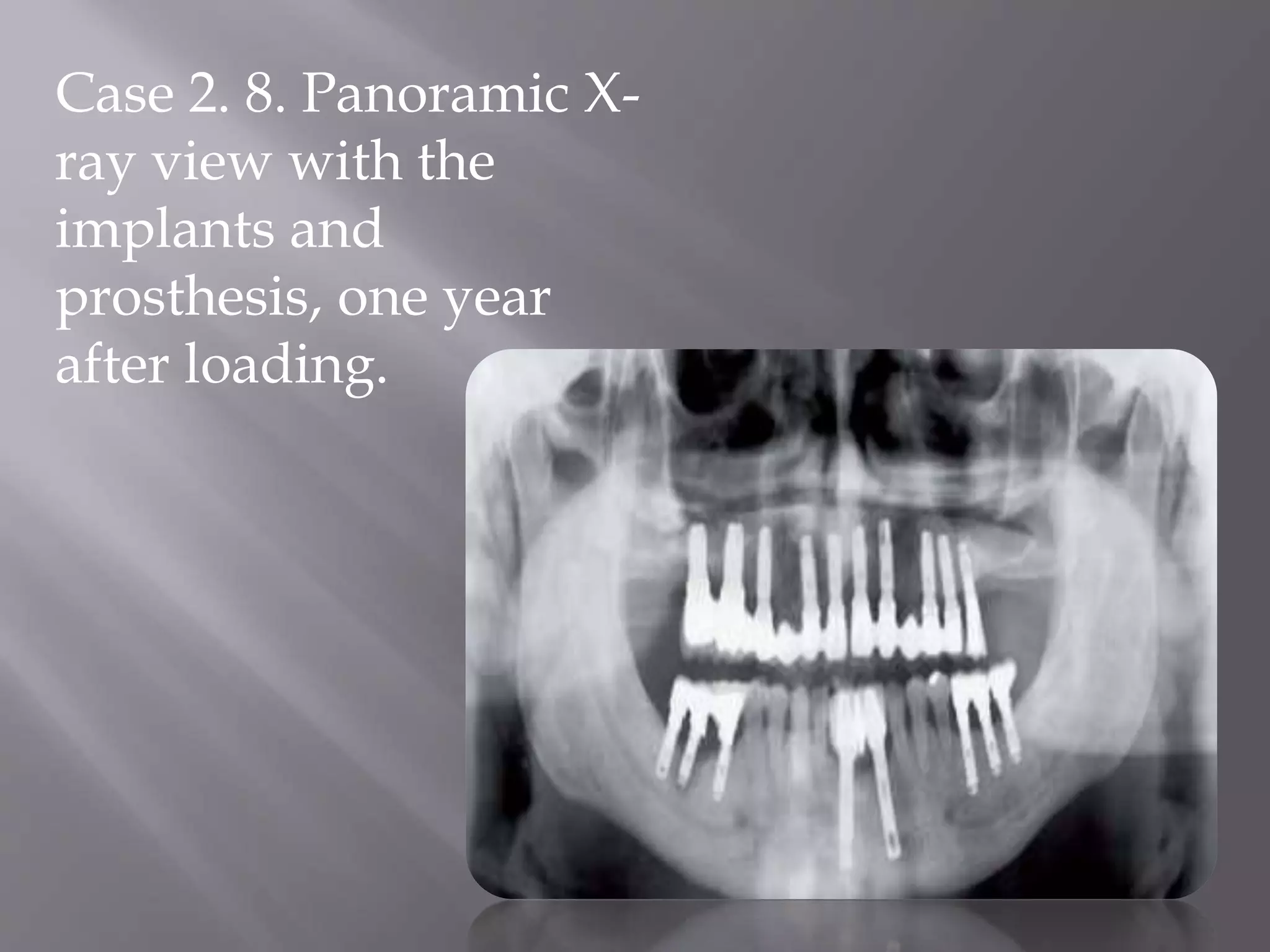 transcrestal sinus lift with implant placement-balloon technique | PPTX | Ear, Nose and Throat ...