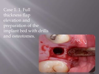 transcrestal sinus lift with implant placement-balloon technique | PPTX | Ear, Nose and Throat ...