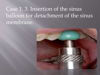 transcrestal sinus lift with implant placement-balloon technique | PPTX ...