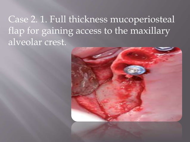 transcrestal sinus lift with implant placement-balloon technique | PPTX | Ear, Nose and Throat ...