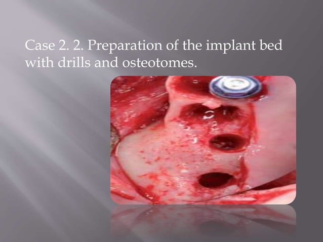 transcrestal sinus lift with implant placement-balloon technique | PPTX | Ear, Nose and Throat ...