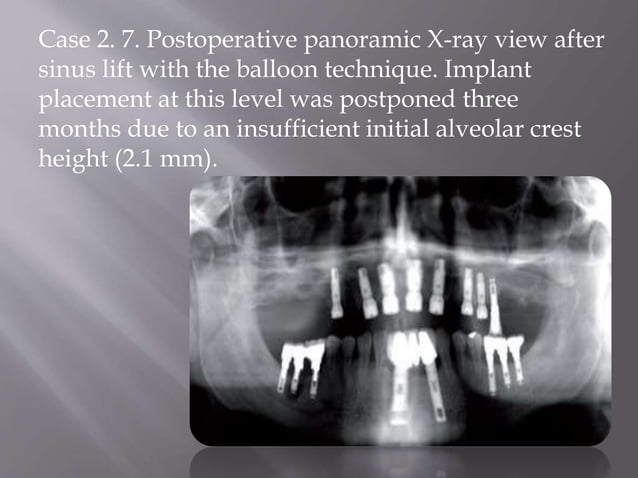 transcrestal sinus lift with implant placement-balloon technique | PPTX | Ear, Nose and Throat ...