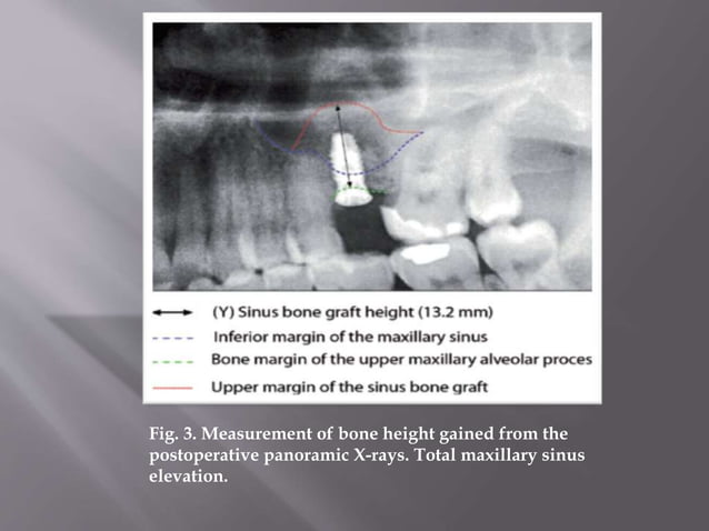 transcrestal sinus lift with implant placement-balloon technique | PPTX ...