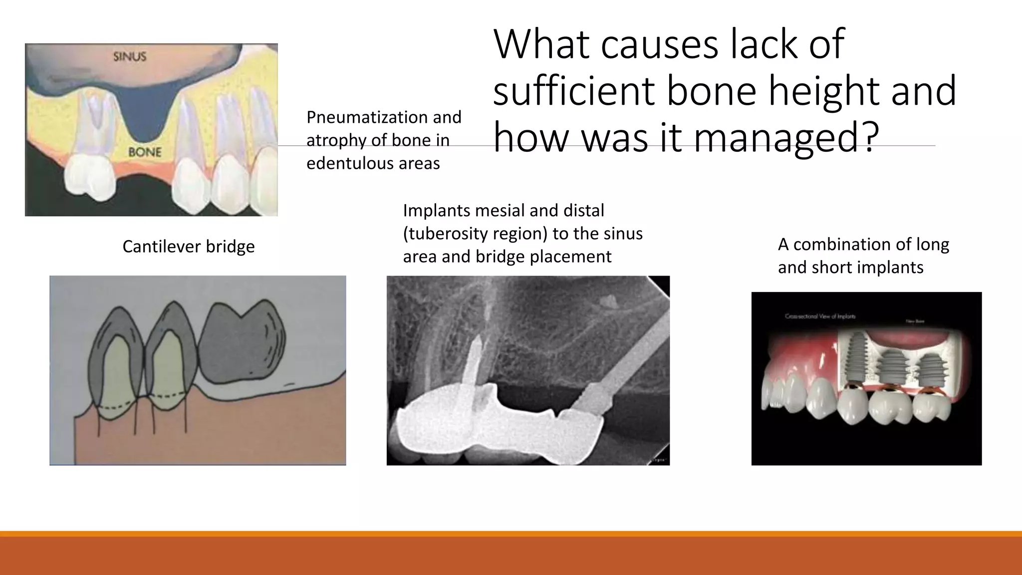 Sinus floor elevation | PPTX