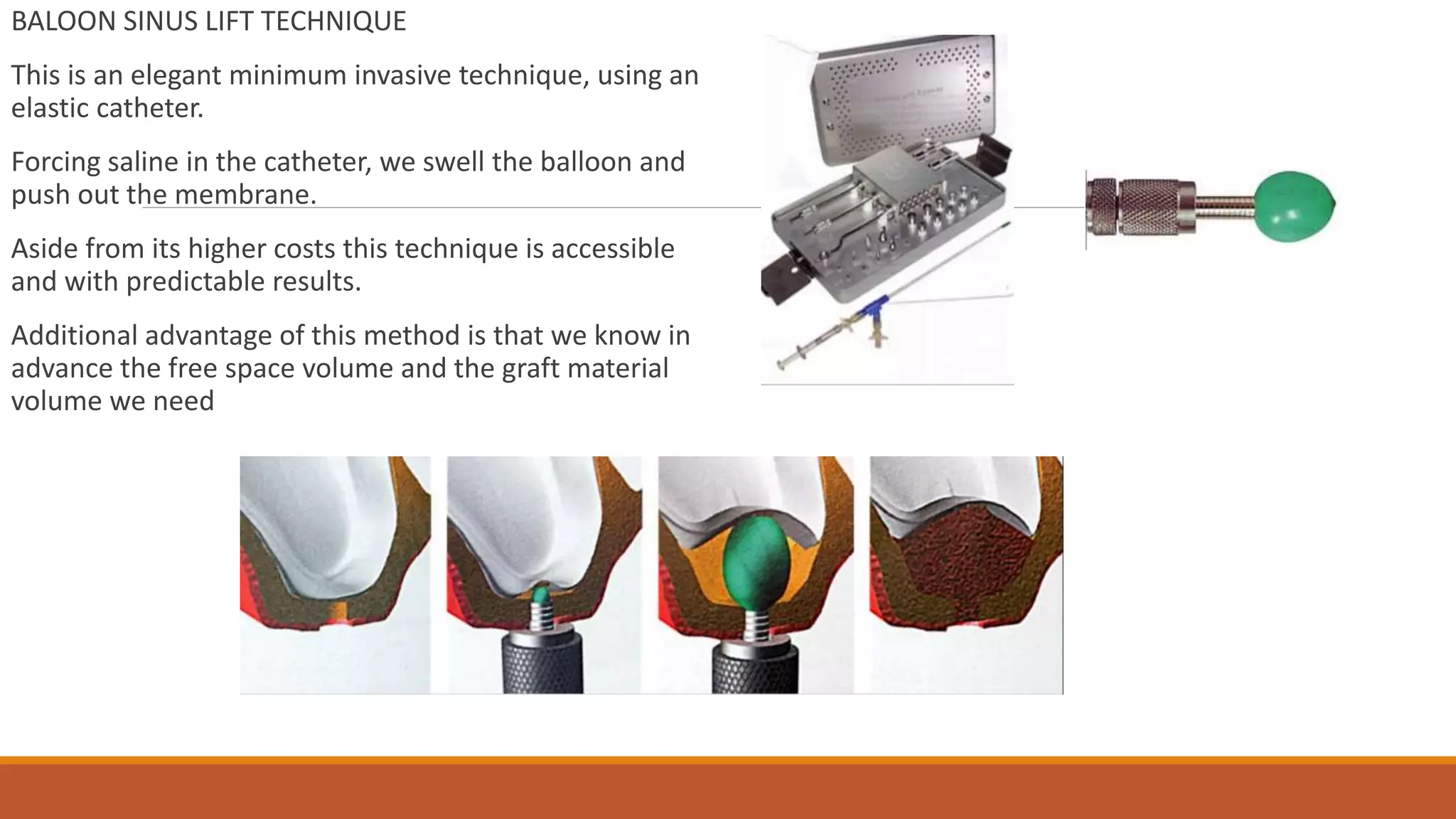 Sinus floor elevation | PPTX