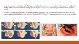 Sinus floor elevation | PPTX