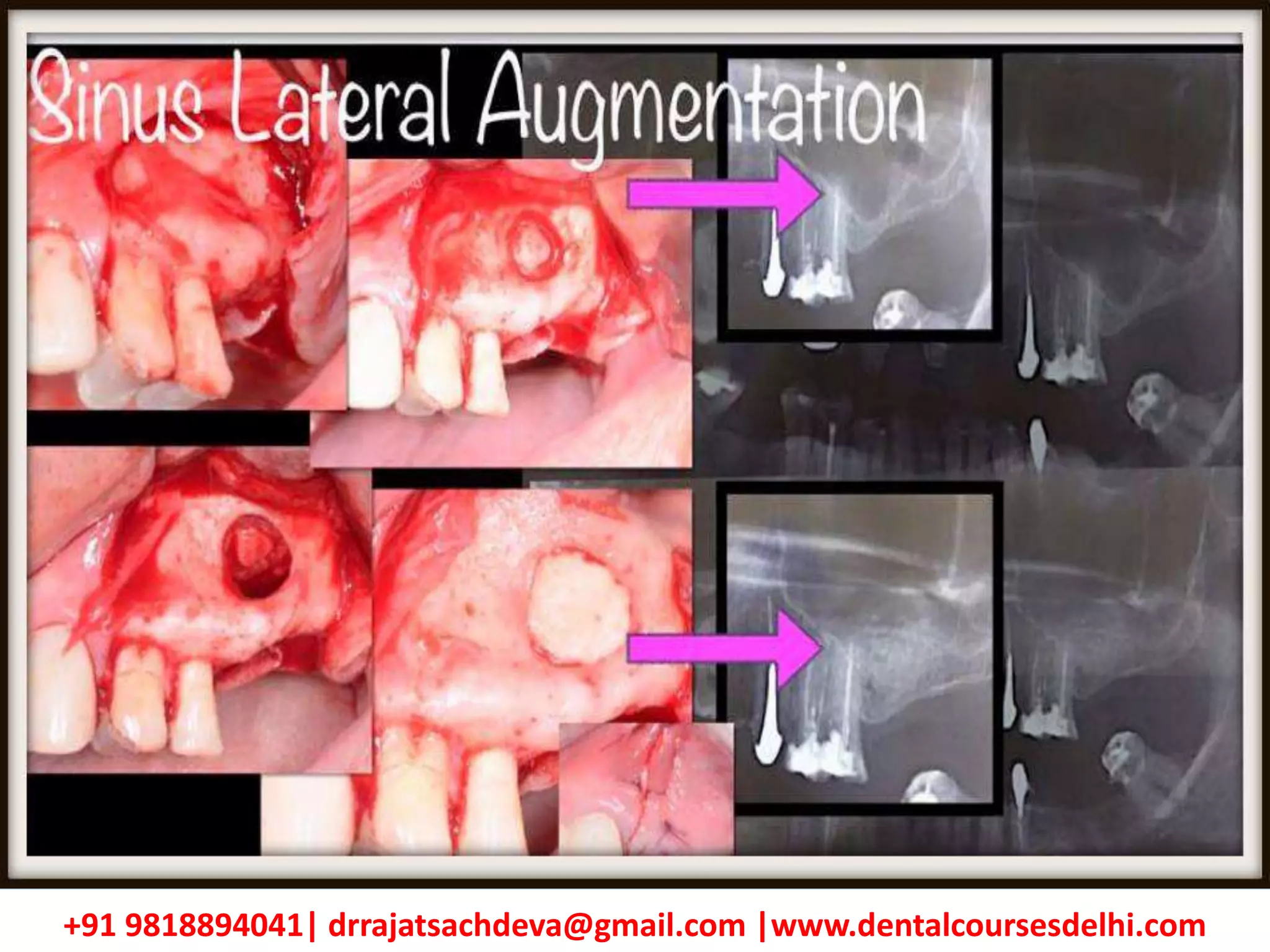 Sinus lift Technique| Direct and Indirect Sinus Lift Technique| | PPTX