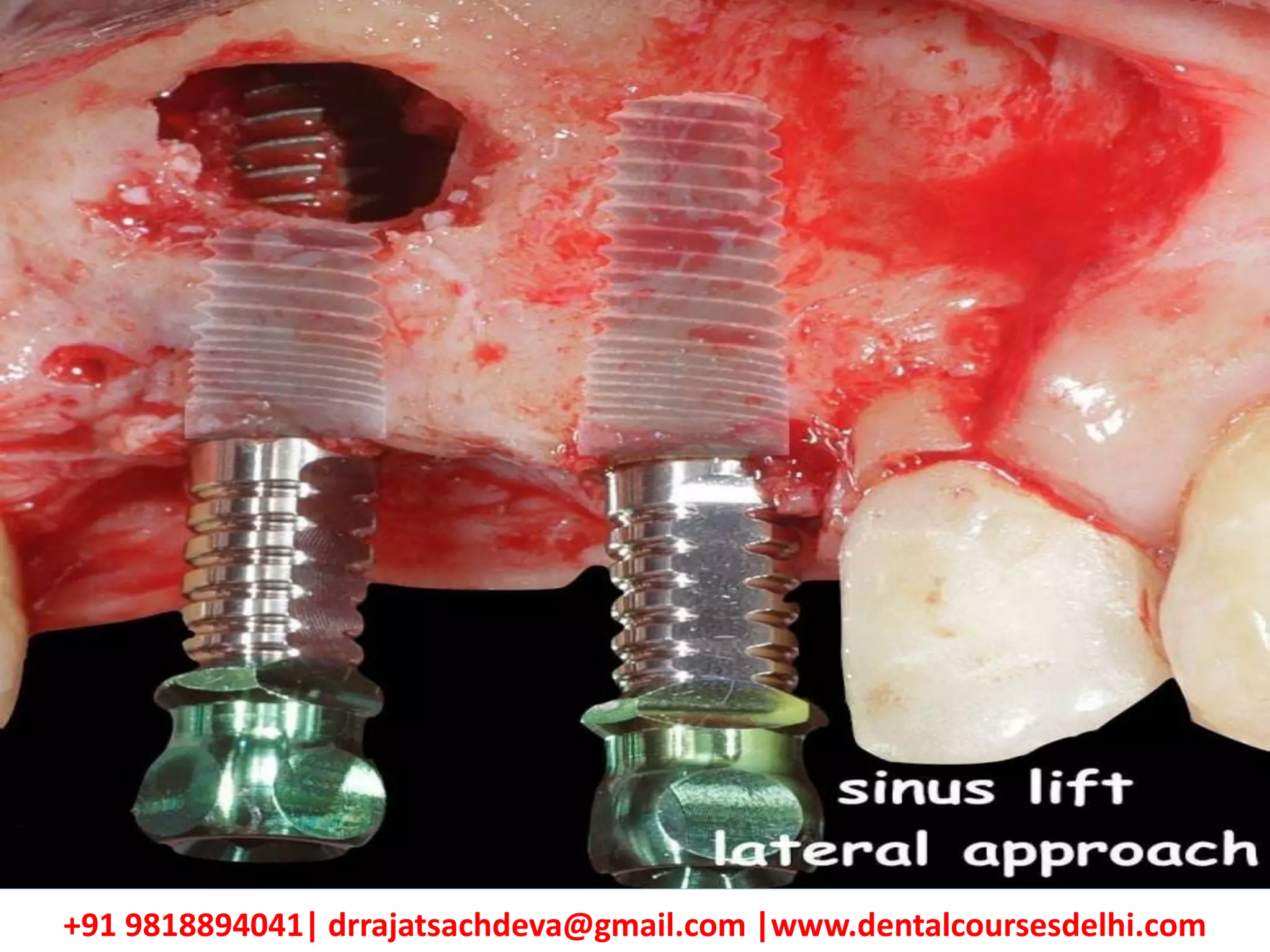 Sinus lift Technique| Direct and Indirect Sinus Lift Technique| | PPTX
