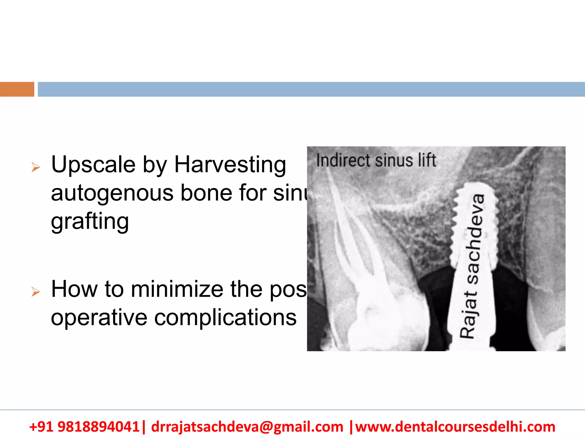 Sinus lift Technique| Direct and Indirect Sinus Lift Technique| | PPTX