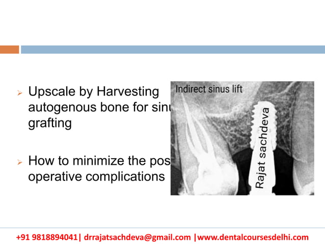 Sinus lift Technique| Direct and Indirect Sinus Lift Technique| | PPTX ...