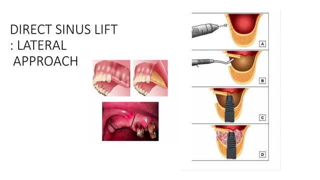 SINUS LIFT AUGMENTATION presentation.pptx