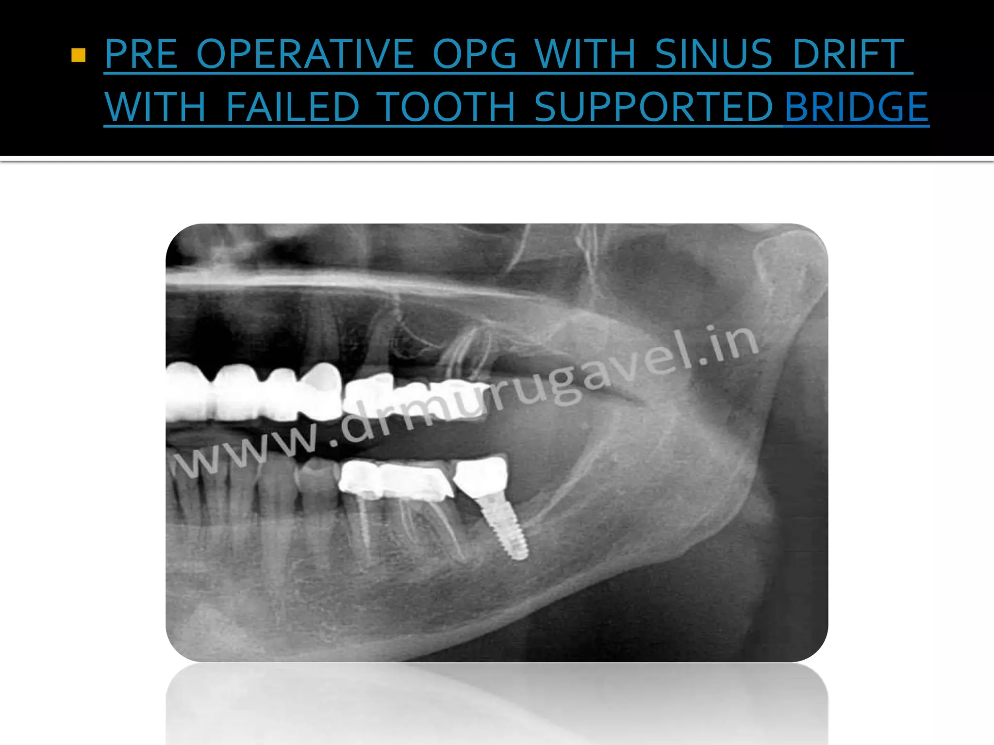 Sinus lift and its alternatives-pterygoid implants and basal implants | PPTX