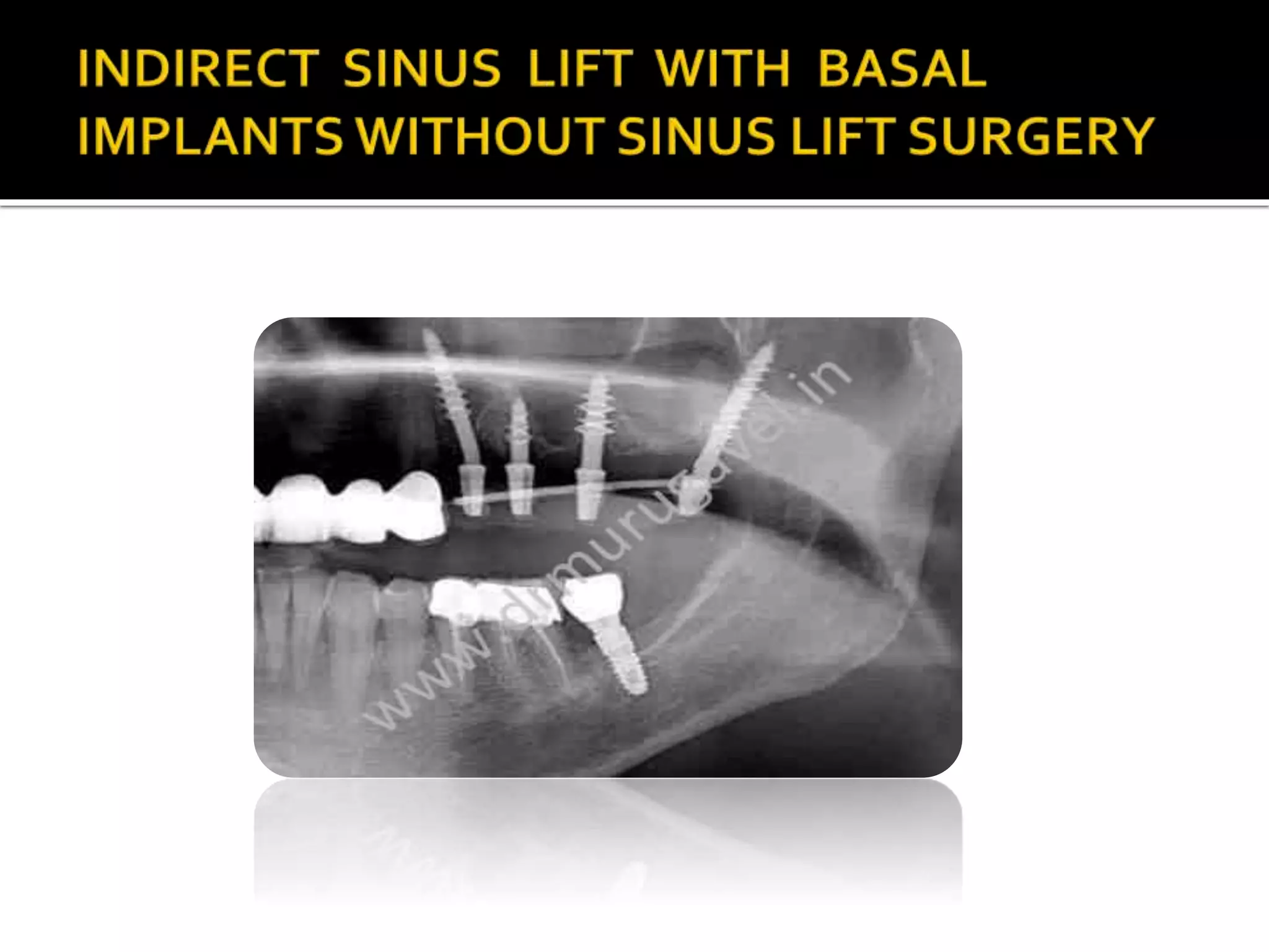 Sinus lift and its alternatives-pterygoid implants and basal implants ...