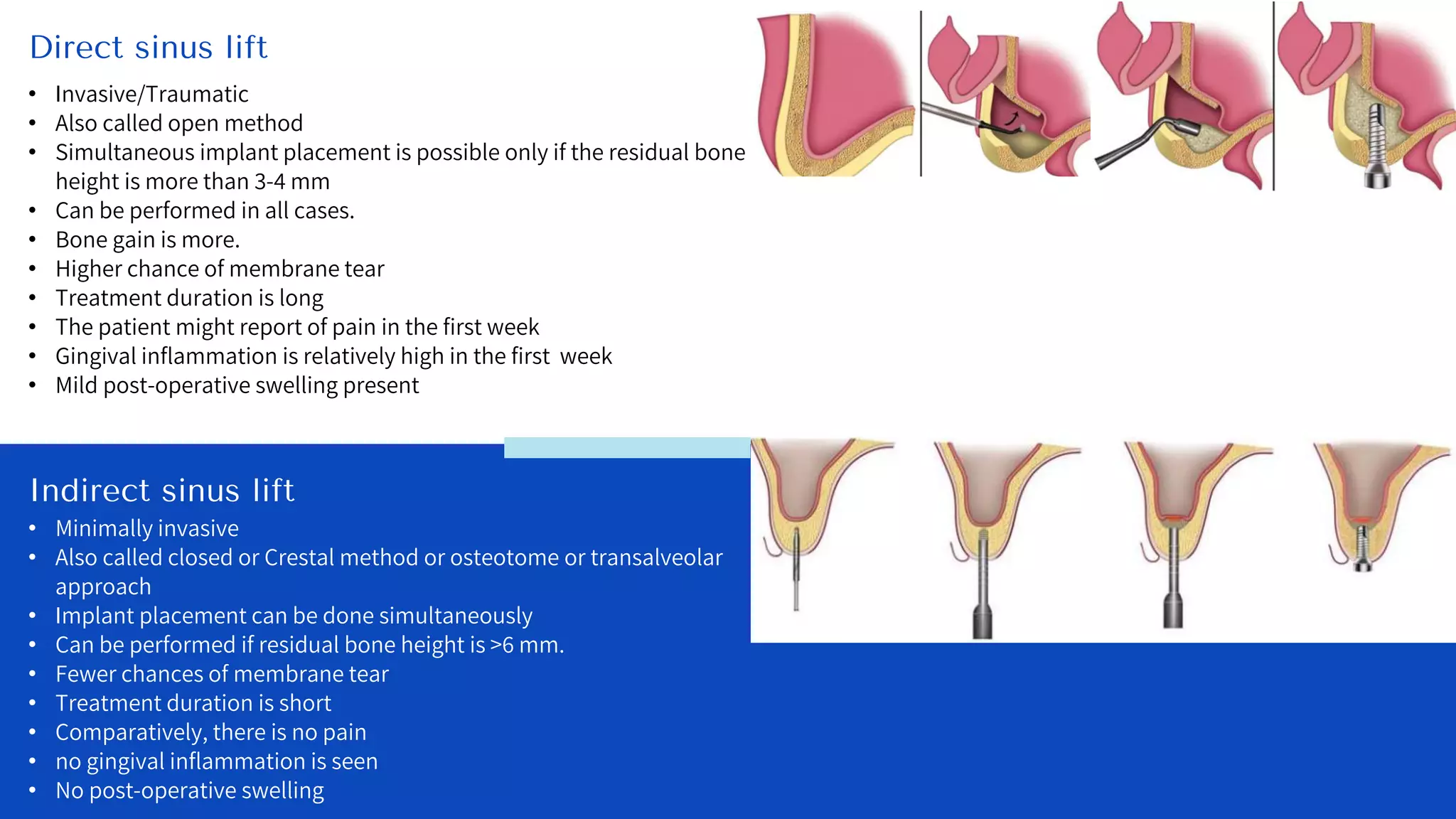 sinus lift | PPTX