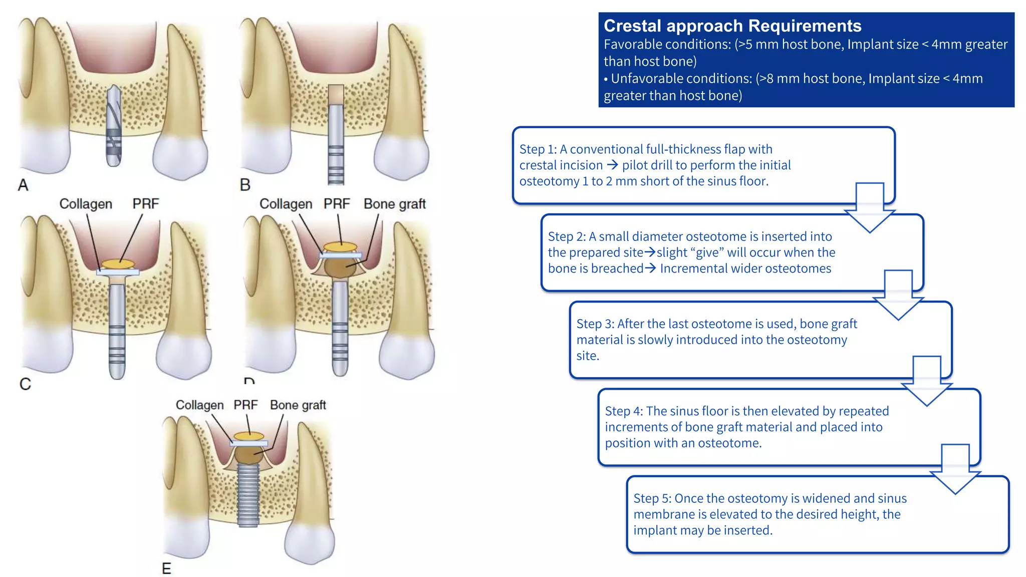 sinus lift | PPTX