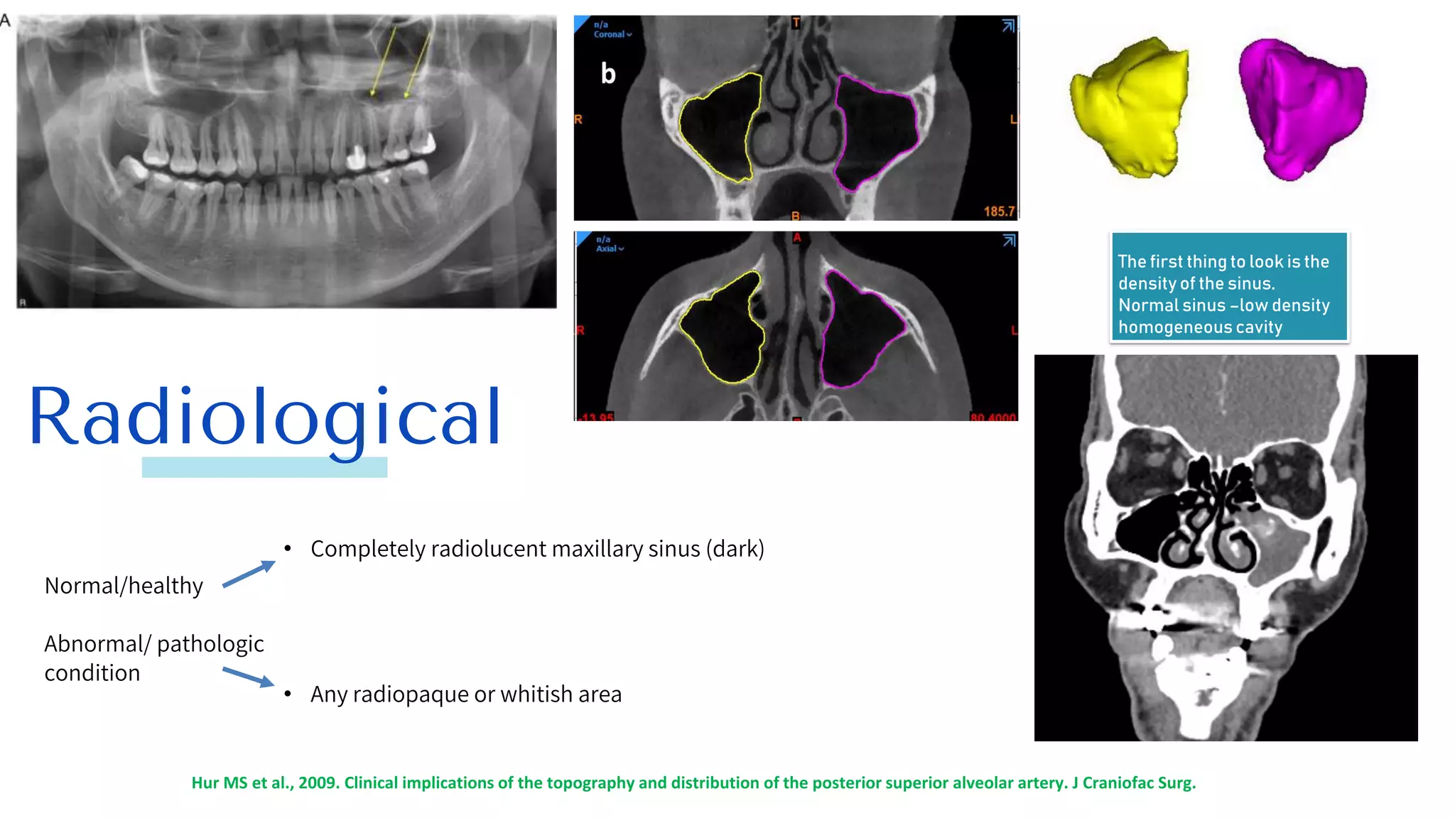 sinus lift | PPTX