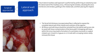 sinus lift | PPTX