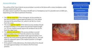 sinus lift | PPTX