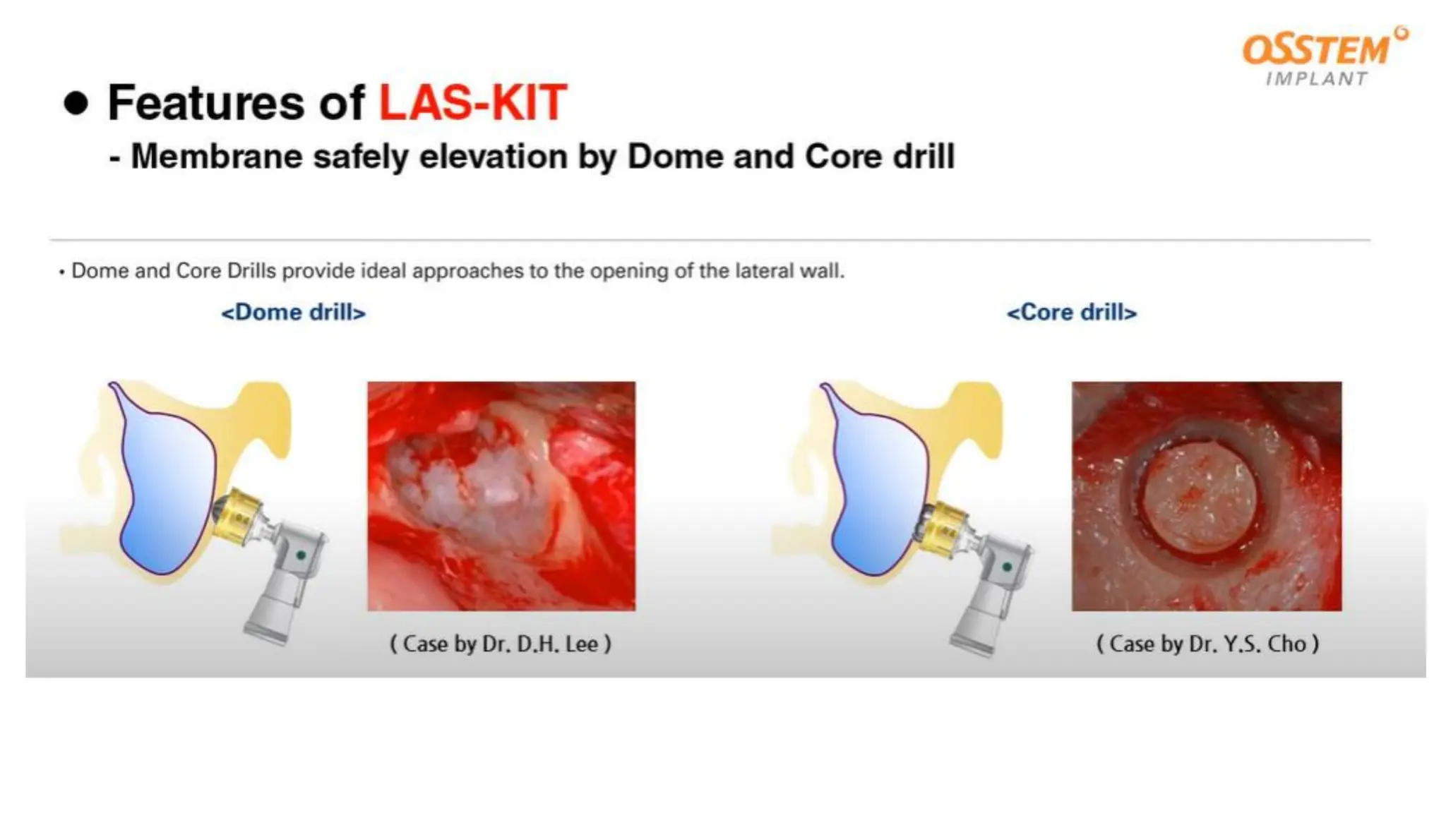 Sinus Lift illustration (step by step procedure).pdf