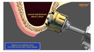 Sinus Lift illustration (step by step procedure).pdf