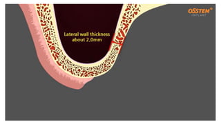 Sinus Lift illustration (step by step procedure).pdf
