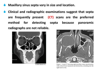 Sinus lifting basic | PPTX