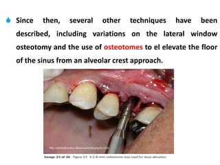 Sinus lifting basic | PPTX