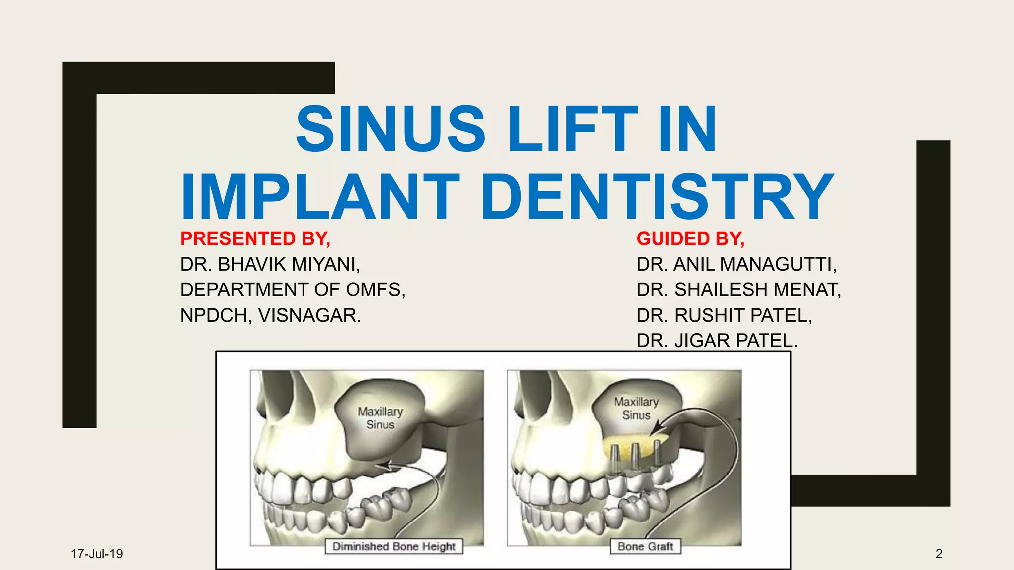 "Sinus Lift in Implant Dentistry" | PPTX
