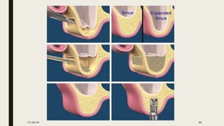 "Sinus Lift in Implant Dentistry" | PPTX